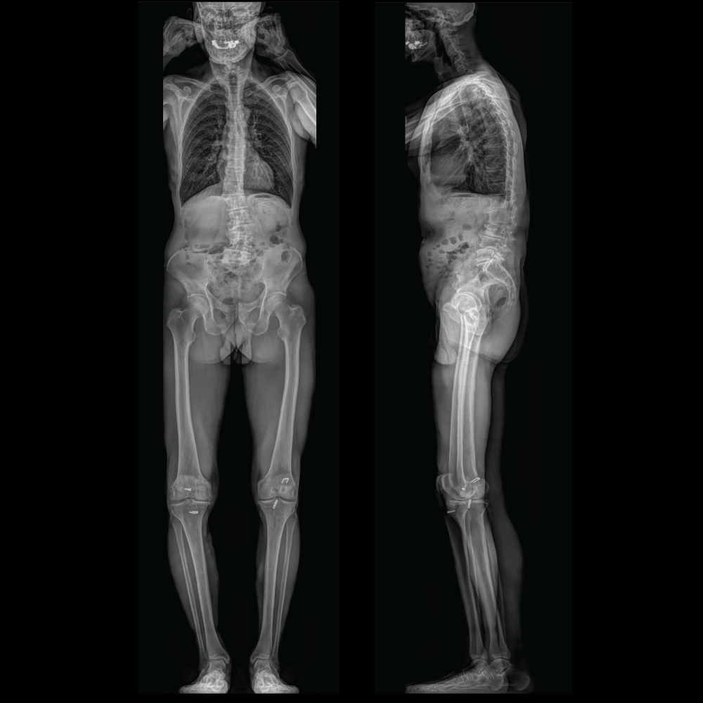 EOSedge X-ray | McBride Orthopedic Hospital